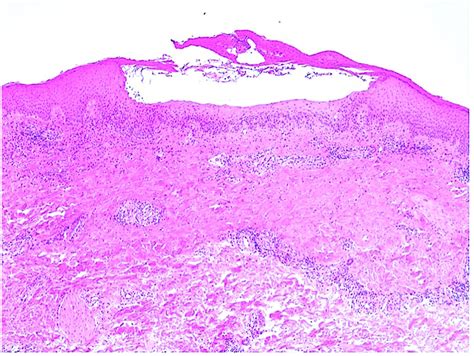 Acanthotic Epidermis Moderate Spongiosis And An Intraepidermal Bulla