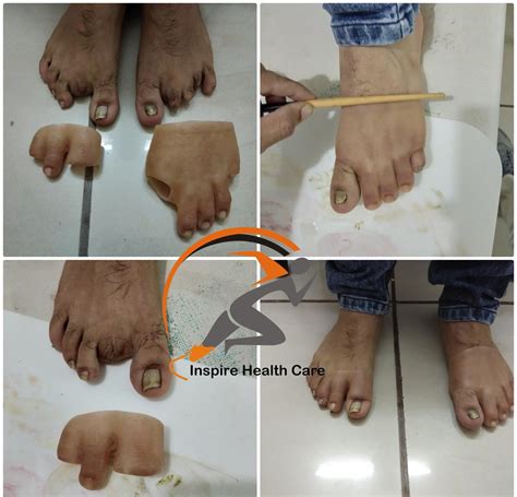 Inspire Structure Lower Extremity Prosthesis