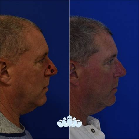 Med Spa Specials In Charlotte Nc Dilworth Facial Plastic Surgery