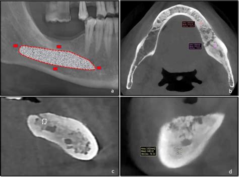 Structure Of Maxillary Tuberosity Semantic Scholar