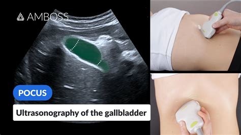 Gallbladder Ultrasound Scan London Private Ultrasound