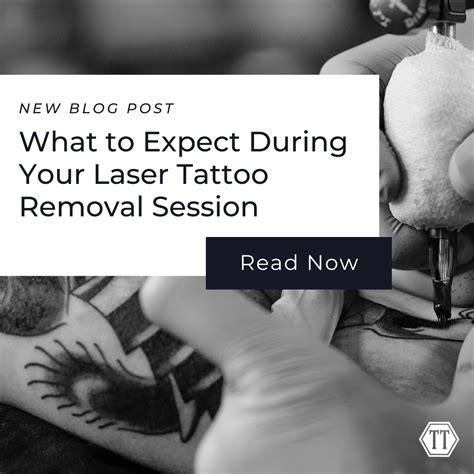 What To Expect During Your Laser Tattoo Removal Session Sounds