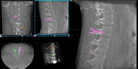 Can The Intelligent Spine Navigator Robot Perform Spine Surgery Successfull？how Will We Choose