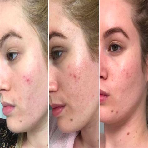 24 Products To Help You Deal With Acne Scars