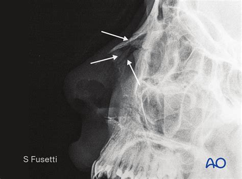 Examination Of Patients With Nasal Bone Fractures