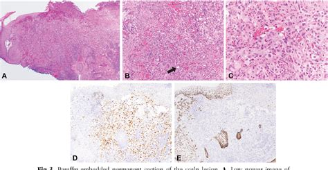 Figure 3 From Cutaneous Angiosarcoma Of The Scalp In A Pediatric