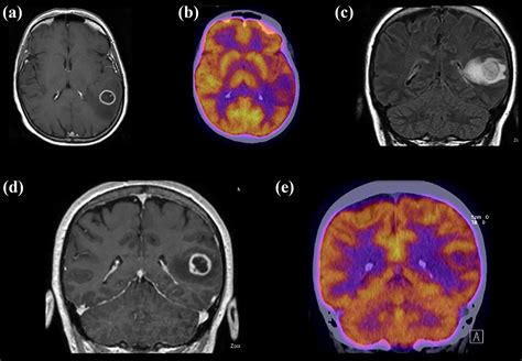 Distinguishing Radiation Necrosis From Tumor Progression 42 Off