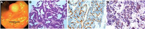 A Polypoid Lesion In The Terminal Ileum Seen On Colonoscopy B
