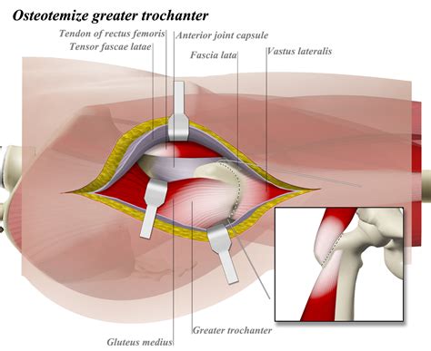 What Is Lateral Hip Replacement Surgery