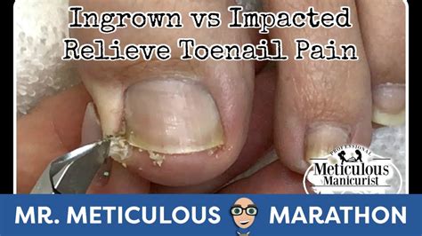 Ingrown Toenail Prevention