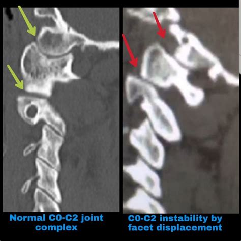Ismael Peralta On Linkedin Neurocirujano Exoscope Neurosurgery Neurosurgeon