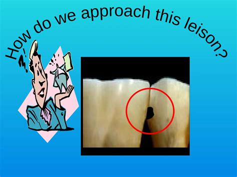 Class Ii Cavity Preparation For Amalgam Pptx Oral Care Personal Care