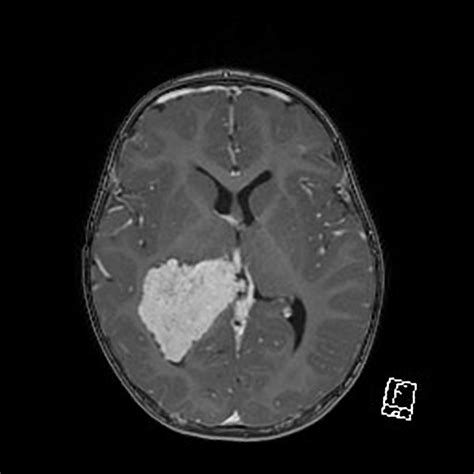 Choroid Plexus Papilloma Cpp Pacs