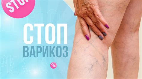 Почему операция не спасёт от варикоза и как улучшить состояние вен самостоятельно Стань краше