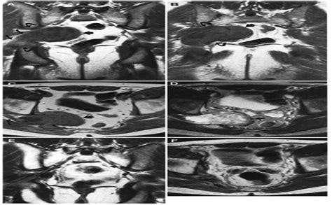 Hemangiopericytoma Of The Sciatic Notch Presenting As Sciati