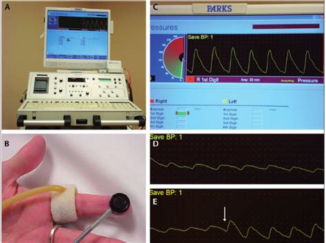An Overview Of Dialysis Access Associated Steal Syndrome Renal Fellow