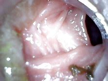 Endoscope Tube Search Videos