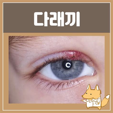 속다래끼 증상 눈다래끼 증상 원인 다래끼 초기증상 전염 다래끼빨리낫는법 콩다래끼 눈꺼풀 부음 네이버 블로그