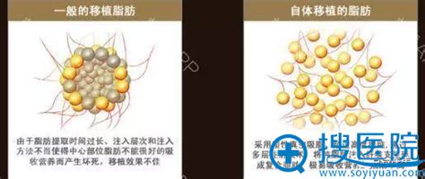 韩国原辰医院朴原辰自体脂肪丰胸Q A 自体脂肪丰胸成活率98 注射丰胸 搜医院