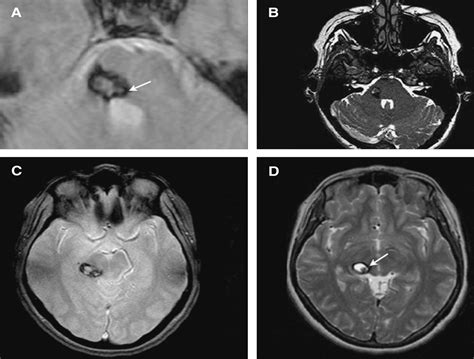 Brainstem Cavernous Malformations Neurosurgery