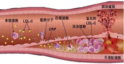吸烟与动脉粥样硬化