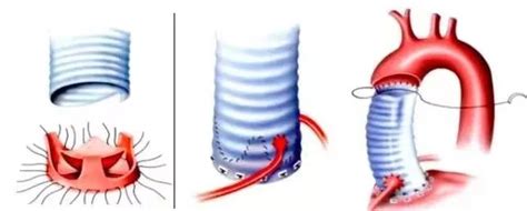 “david手术”赋予主动脉根部新生命——青大附院心脏血管外科成功开展首例“david手术” 青海大学附属医院