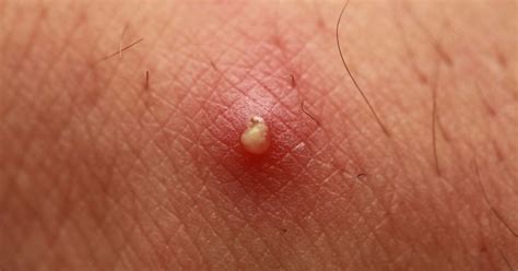 Causes Symptoms And Treatment Of Skin Boils 53 Off