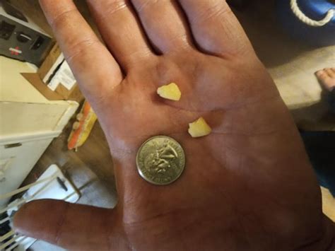 Removed Some Stones To Ring In The New Year Rtonsilstones