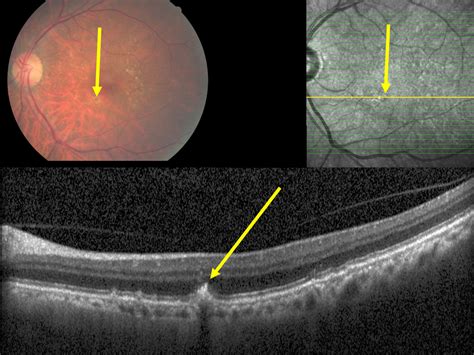 Intraretinal Hyperreflective Bodies In Intermediate Late Amd Relate To