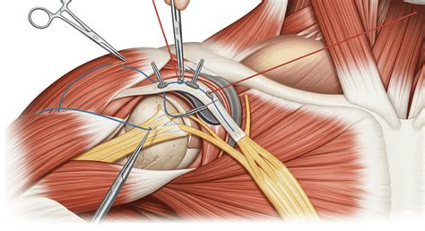 Shoulder Stabilisation Surgery 2025