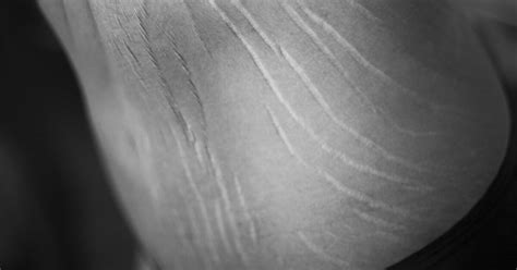 Seksualitet Hos Personer Med Demens Kan Være Til Glede Og Besvær