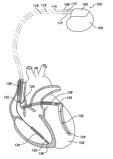 Ventricular Rate Patented Technology Retrieval Search Results Eureka