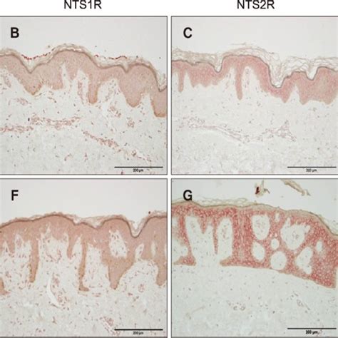 Review Of Previously Reported Cases Of Coccygeal Polypoid Eccrine Nevus