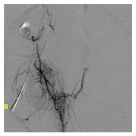 Post Embolization Arteriogram Of The Left Internal Pudendal Artery