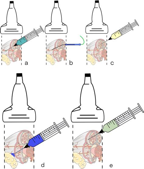 Intervention Types A Sclerosing Agent Under Doppler Guidance