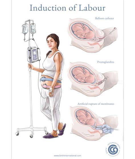 Induction Labour How It Works At Evie Rounsevell Blog