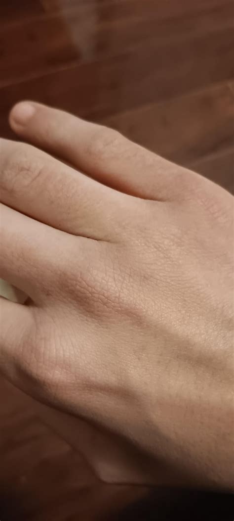Why Is The Skin Next To My Knuckles So Rough R Skin