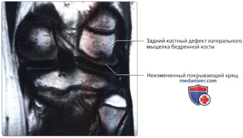 Варианты развития латерального мыщелка бедренной кости на