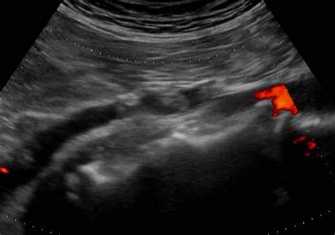 Urinary Tract And Male Reproductive System 22 Bladder Case 221