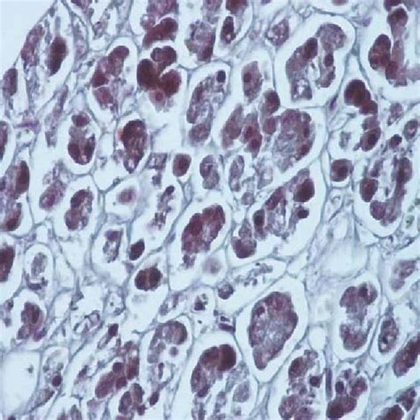 Stromal Tissue With A Periacinar Disposition At The Level Of The Head