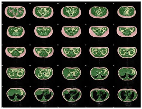 Result For Automatic Segmentation Of Lean Tissue Green Non Visceral