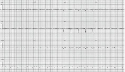 Scielo Brasil Hypertrophic Cardiomyopathy All Phenotypes In One