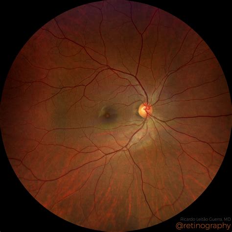 Central Serous Chorioretinopathy Retinography