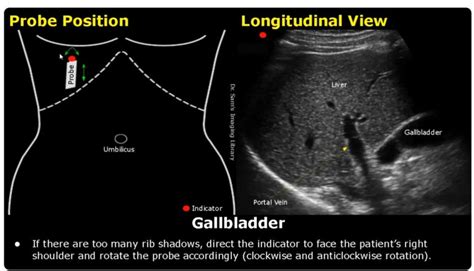 This Entry Was Posted In Dr Sams Imaging Library Gallbladder Ultrasound Probe Positioning