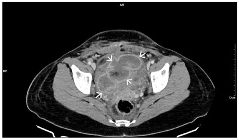 Computed Tomography Image Illustrating A Bladder Flap Haematoma With