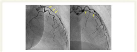 Angiogram Control Days After Onset Of Symptoms Showing An Extension Download Scientific