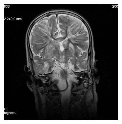 Fse T2wi Coronal Plane Callosal Injury As A Result Of Multiple