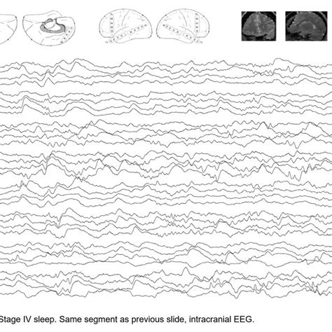 Fig Deep Slow Wave N Sleep Intracranial EEG Same Segment As Fig Download Scientific