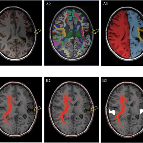 Imaging Methods A The Freesurfer Method Performed Semi Automated