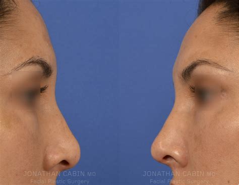 Non Surgical Rhinoplasty Cabinmd Facial Plastics And Aesthetics